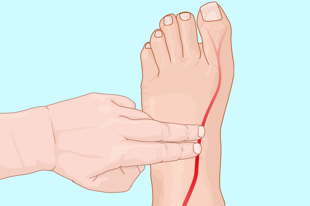 آیا آمبولی پا خطرناک است؟ | دکتر توفیق متخصص عروق